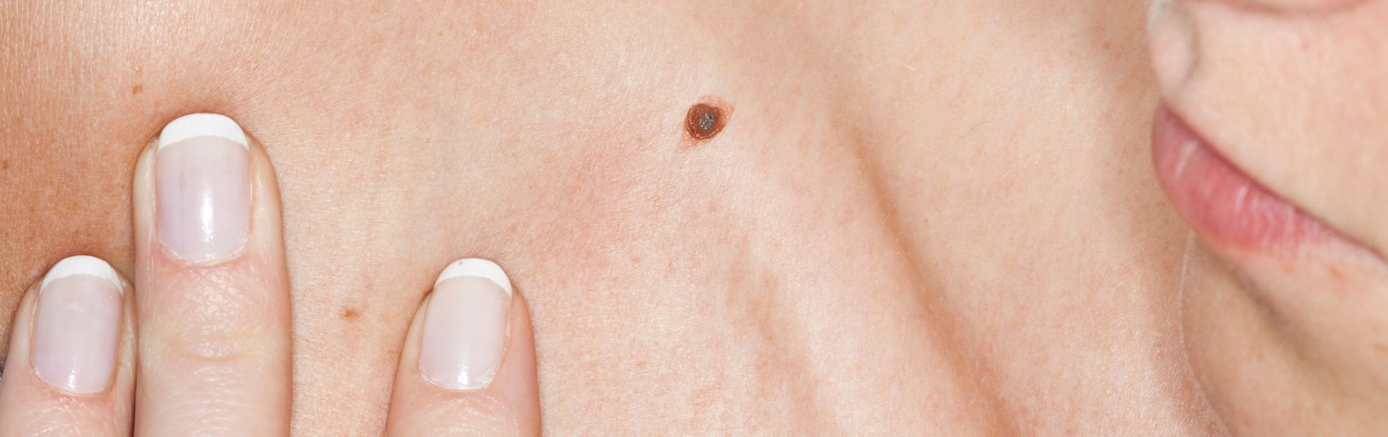 Understanding Melanoma: Risk, Diagnosis, and What to Expect | Skin ...