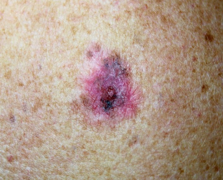 Skin Cancer Risk Factors NZ | Are You at Risk? | Skin Institute